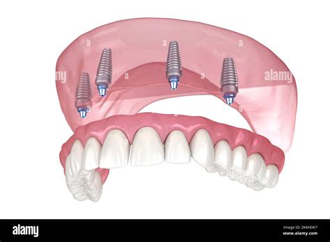 Maxillary Prosthesis With Gum All On 4 System Supported By Implants Medically Accurate 3d