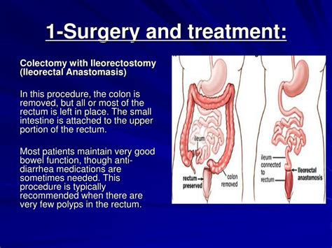 Ppt Colon Cancer Powerpoint Presentation Free Download Id 3297970