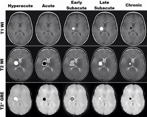Stages Of Cerebral Hemorrhage The Appearance And Evaluation Of Intracranial Hemorrhage On Mri