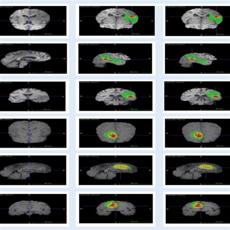 Visualization Of Brats 2017 Dataset Mri Image Ground Truth And Download Scientific Diagram