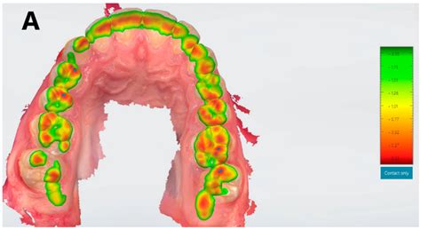 Digital Occlusal Analysis At Alyssa Coode Blog