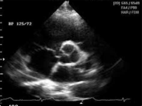 Psax Views Measurements Flashcards Quizlet