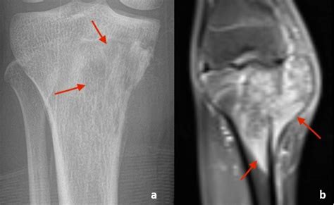 Top 10 Facts To Know About Bone Lesions Identified On Radiographs Published In Journal Of The