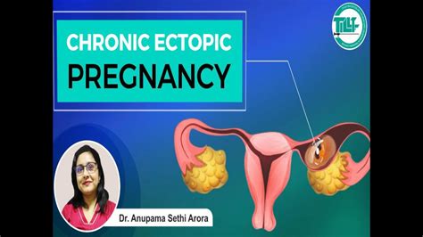Chronic Ectopic Pregnancy Done By Dr Anupama Sethi Youtube
