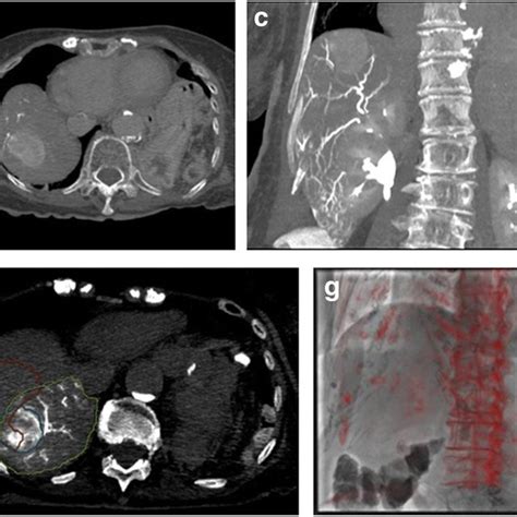 Example Of Liver Ablation And Embolization Performed In An Act Room