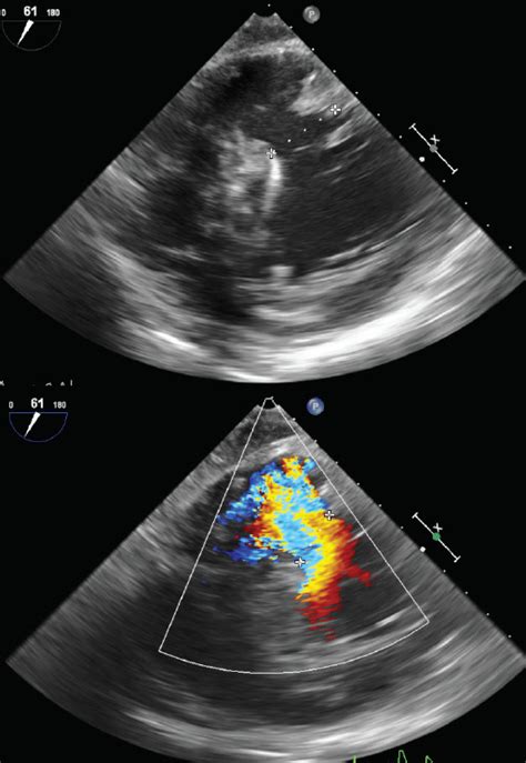 Successful Treatment Of Ischaemic Vsd And Acute Rv Failure A