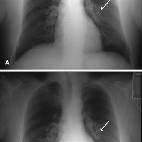[pdf] Cryptococcus Gattii An Emerging Cause Of Pulmonary Nodules