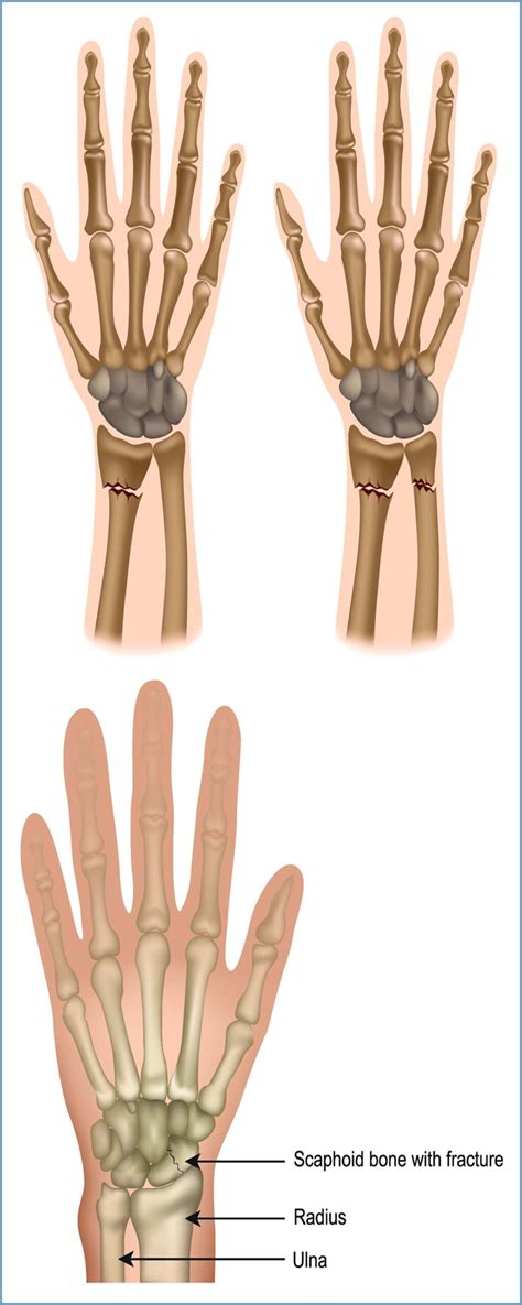 Distal Radius Scaphoid Wrist Fractures Yellowstone Surgery Center