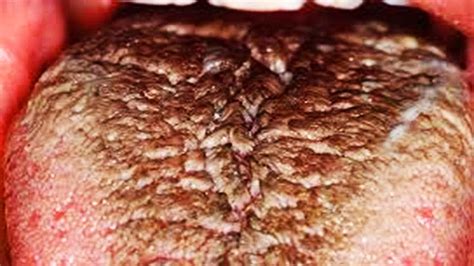 Black Hairy Tongue Gross Fissured Tongues And Tongue Health Youtube