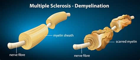 Multiple Sclerosis Causes Diagnosis And Treatment
