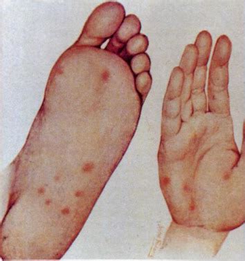 A Consideration Of The Differences Between A Janeways Lesion And An