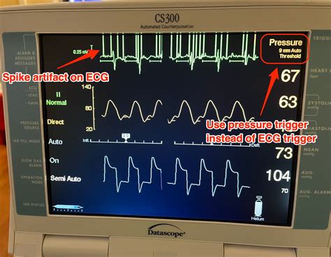 Heres A Fun Icu Puzzle What Is Causing This Crazy Spiking Pattern On The Ecg Waveform Of Both