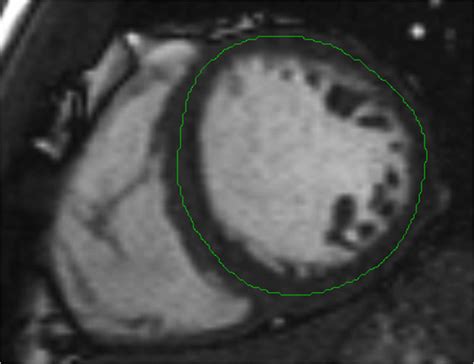 A Short Axis Image With A Contour Drawn In The Mid Wall Of The Left Download Scientific Diagram