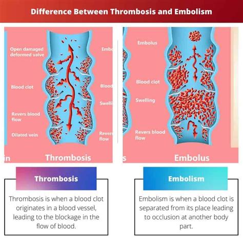 Thrombose Vs Embolie Différence Et Comparaison