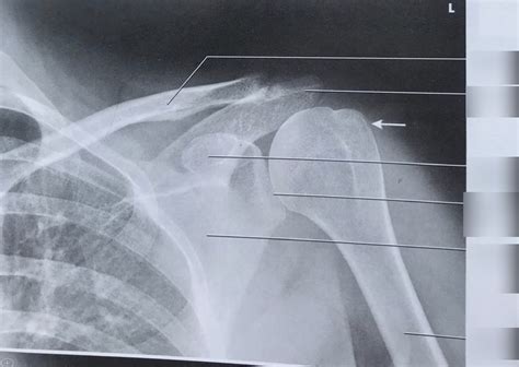 AP Shoulder External Rotation Diagram Quizlet