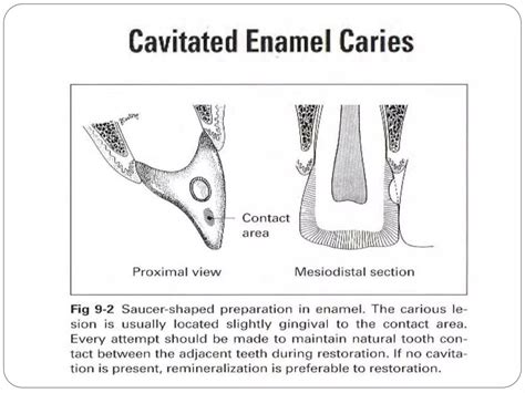 Class Iii Iv V Cavity Preparations For Composites Selvi Pptx