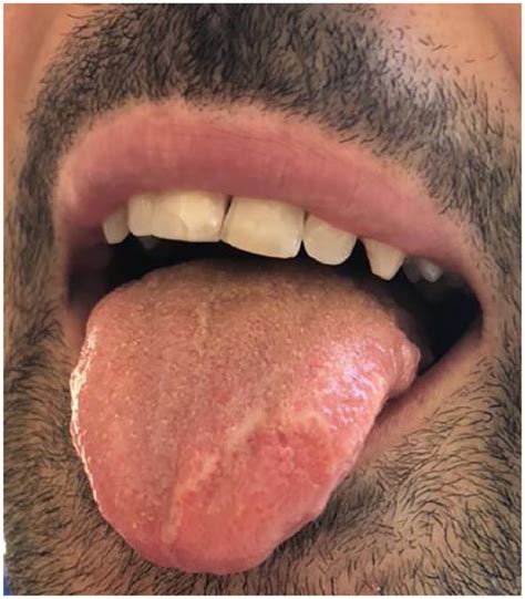 Secondary Syphilis On Tongue