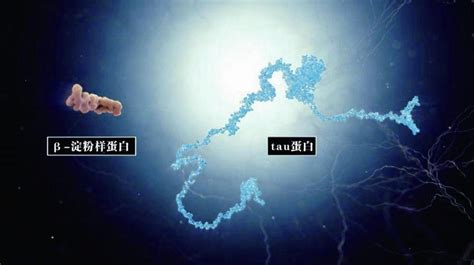 阿尔茨海默病新视野β 淀粉样蛋白毛细血管大脑新浪新闻