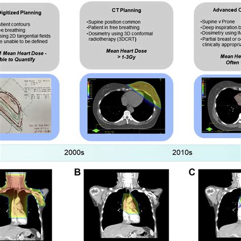 Cases Of Radiation Induced Cardiovascular Disease Download Scientific