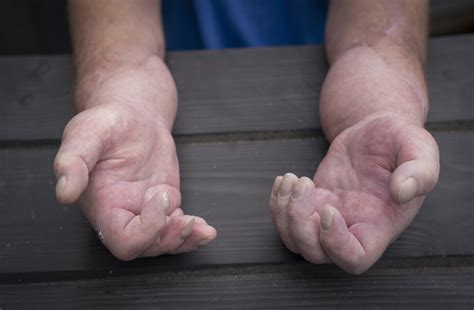 Scleroderma What You Should Know About This Rare Disease