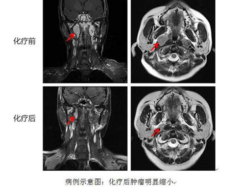 肿瘤防治中心马骏教授团队提高鼻咽癌疗效新方法于顶级杂志《柳叶刀·肿瘤》》发表 中山大学新闻网