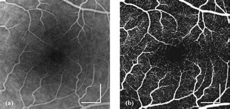 In Vivo Human Retinal Vasculature Images With A Normal Subject The Download Scientific Diagram