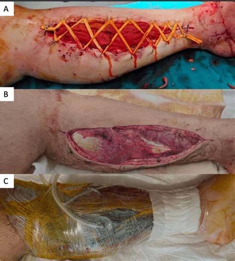 Risk Factors For Surgical Site Infections Following Fasciotomy In