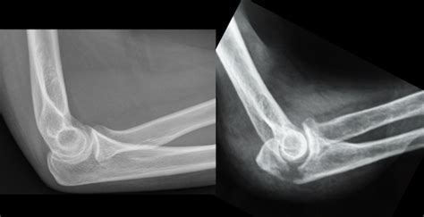 Olecranon Fracture