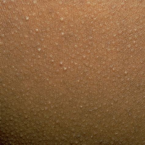 20 Types Of Skin Bumps What They Mean And When To See A Doctor