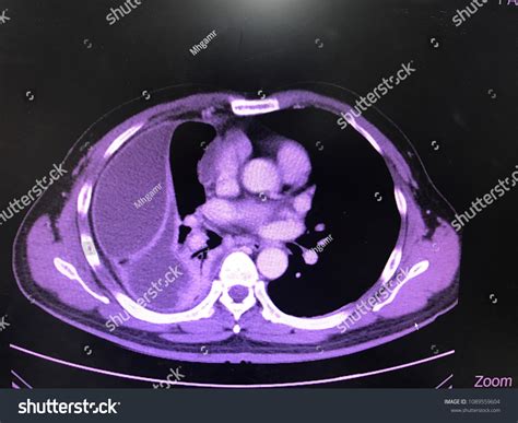 Axial Ct Chest Iv Contrast Show Foto Stock Editar Agora 1089559604