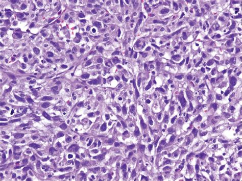 Pulmonary Artery Intimal Sarcoma Diagnosed Using Endobronchial Ultrasound Guided Transbronchial