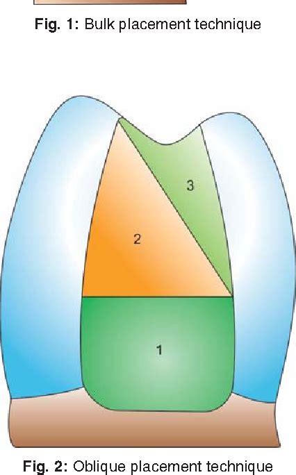 Figure 1 From Effect Of Four Different Placement Techniques On Marginal