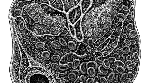 Leukemoid Reaction Vs Cml How To Differentiate And When To Suspect Each Condition