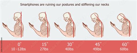 The Bad Smartphone Posturesthe Angle Of Bending Head Related To The