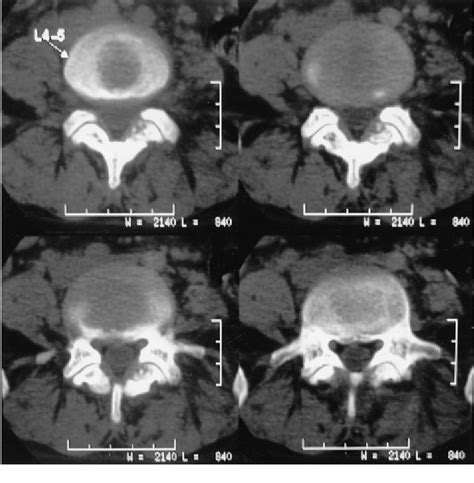 Computed Tomography Scans Demonstrating Hypertrophy Of The Left L4 5
