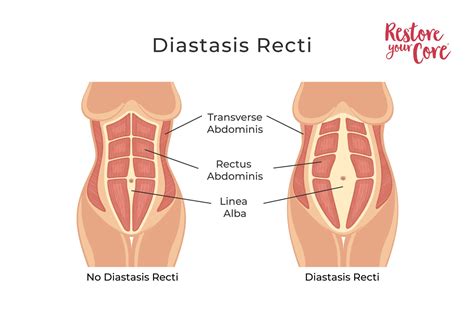 How To Fix Diastasis Recti Years Later A Comprehensive Guide For Long Term Healing Ryc®