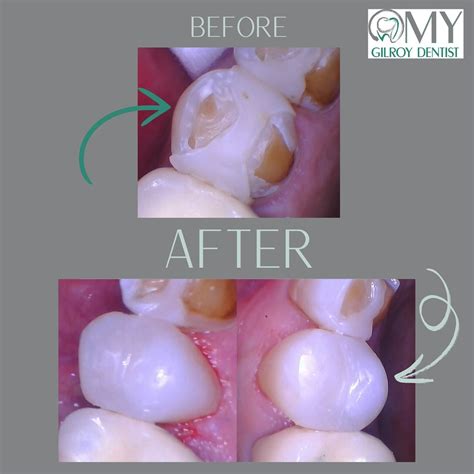 My Rome Wasnt Built In A Day But This Tooth Was Custom Rebuilt With