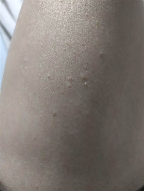 Is This An Hiv Rash Appeared 1 Month After Sex With Stranger It Was Insertive Vaginal Sex With