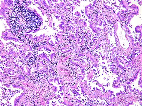 Adenocarcinoma Invasive Acinar Lobectomy Specimen Case Flickr