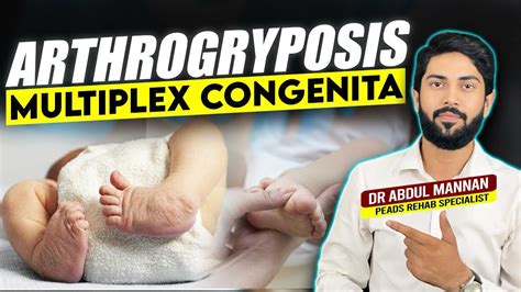 Arthrogryposis Multiplex Congenita In Deutsch Beispielsätze Jfnk