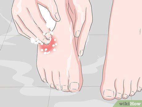 Easy Ways To Reduce Bug Bite Swelling WikiHow