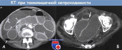 Тонкокишечная непроходимость диагностика