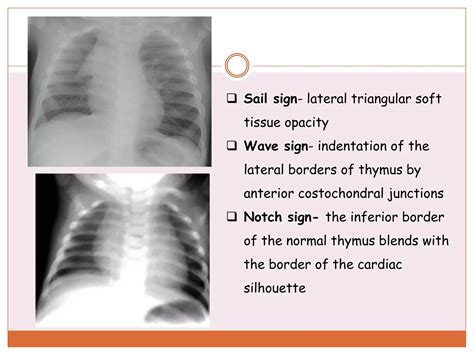 Pediatric Chest Xray Ppt