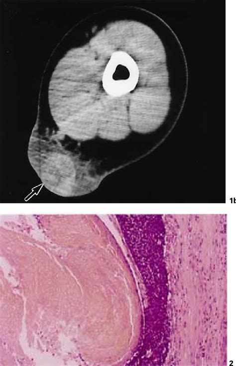 Figure 1 From Extraordinarily Large Calcifying Epithelioma Without Aggressive Behavior