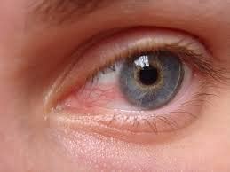 Why Are The Veins In My Eyes Super Red