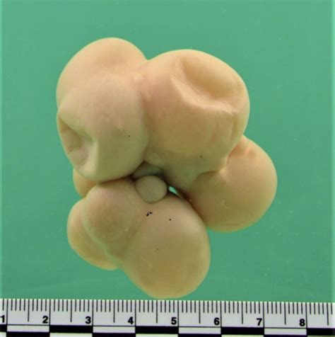 Pathology Of The Non Pregnant Female Genital Tract Flashcards Quizlet