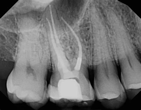 Root Resorption Mason Endodontics And Microsurgery Cincinnati Tooth