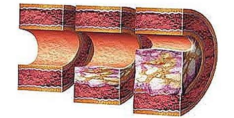 Ateroskleroza Zdravlje