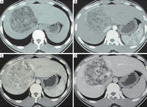 Figure 2 From Diagnosis And Treatment Of Hepatic Angiomyolipoma