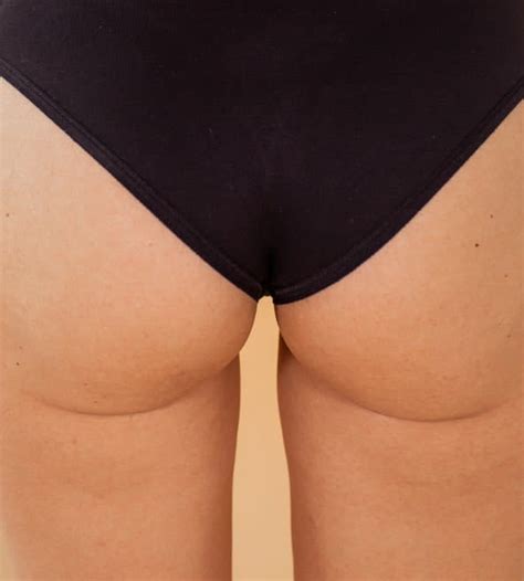Buttocks Reduction Solutions Overview Cost Recovery Before And After Aedit